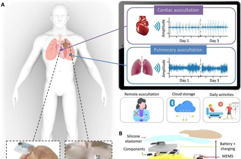 A soft wearable stethoscope designed for automated remote disease ...