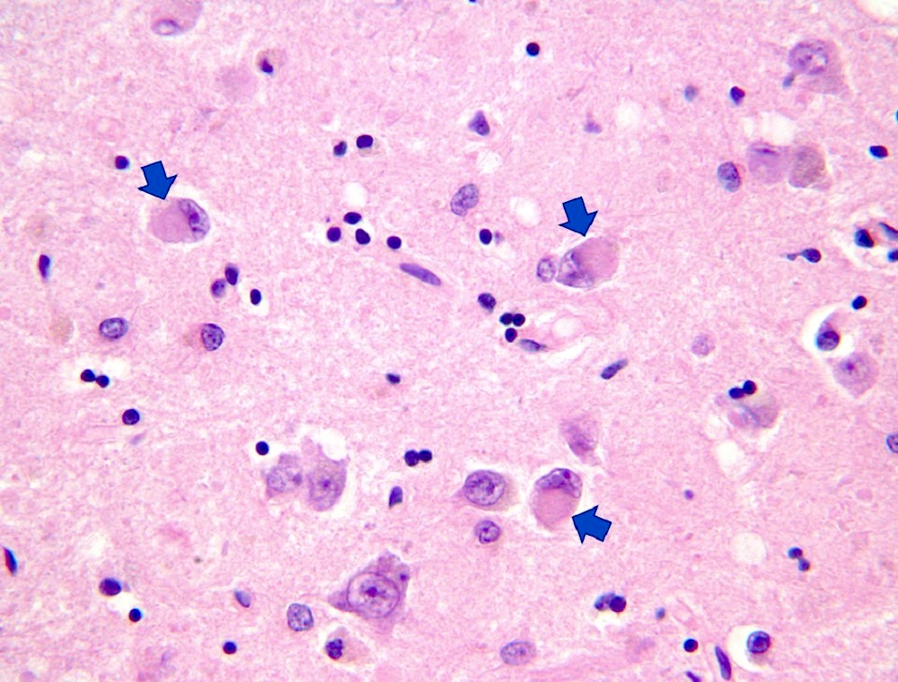 The Many Faces of Dementia - 3 Quarks Daily